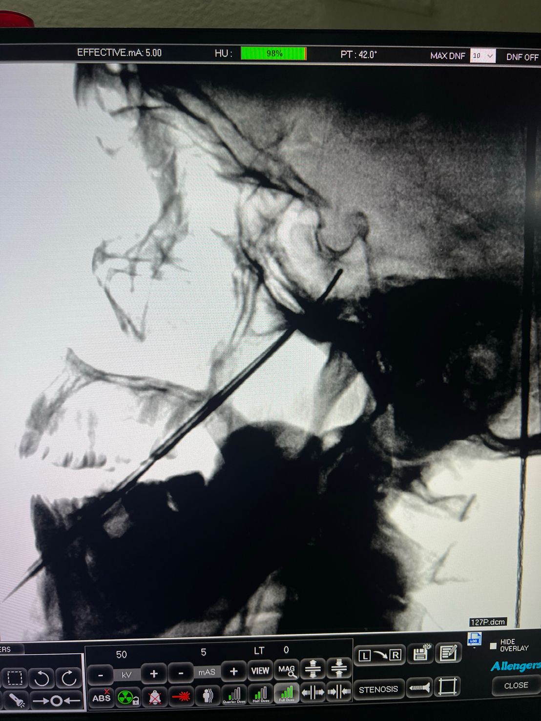 Anshul Agrawal on LinkedIn: A complete procedure for trigeminal ... Anshul Agrawal on LinkedIn: A complete procedure for trigeminal ...