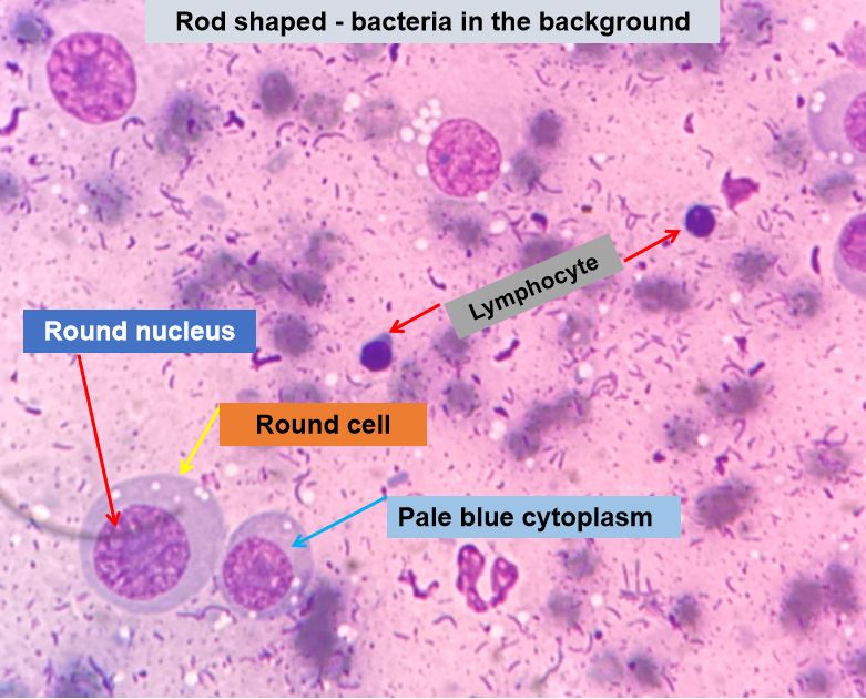 ABHILASH JADHAO on LinkedIn: Adult female with vaginal growth ... ABHILASH JADHAO on LinkedIn: Adult female with vaginal growth ...
