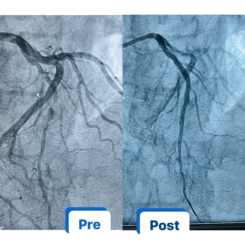 Amit Chowdhury on LinkedIn: Angiography + Long Sigment Angioplasty done ... Amit Chowdhury on LinkedIn: Angiography + Long Sigment Angioplasty done ...