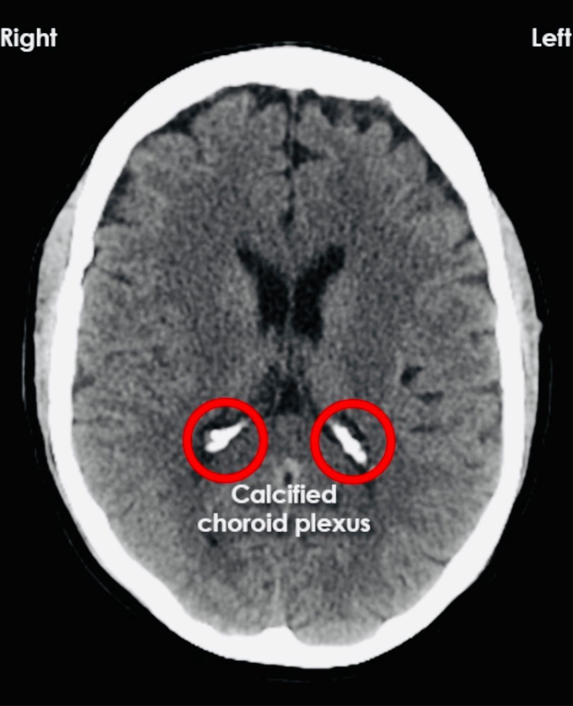 Jijo J. on LinkedIn: CT Brain Anatomy Calcified structures Key points ... Jijo J. on LinkedIn: CT Brain Anatomy Calcified structures Key points ...