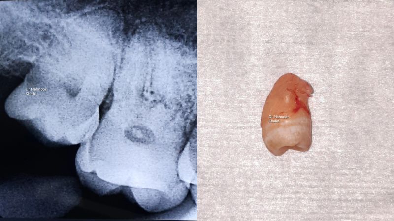 Mahnoor Khalid on LinkedIn: #dentistryworld #oralhealth #oralsurgery # ... Mahnoor Khalid on LinkedIn: #dentistryworld #oralhealth #oralsurgery # ...