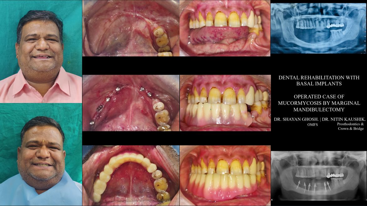 Dr. Shayan Ghosh on LinkedIn: Operated Case of Post Covid Mucormycosis ... Dr. Shayan Ghosh on LinkedIn: Operated Case of Post Covid Mucormycosis ...
