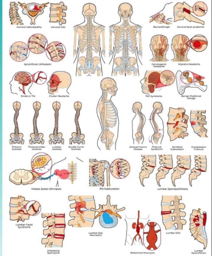 Asma Shahid on LinkedIn: Spinal pathologies. Asma Shahid on LinkedIn: Spinal pathologies.