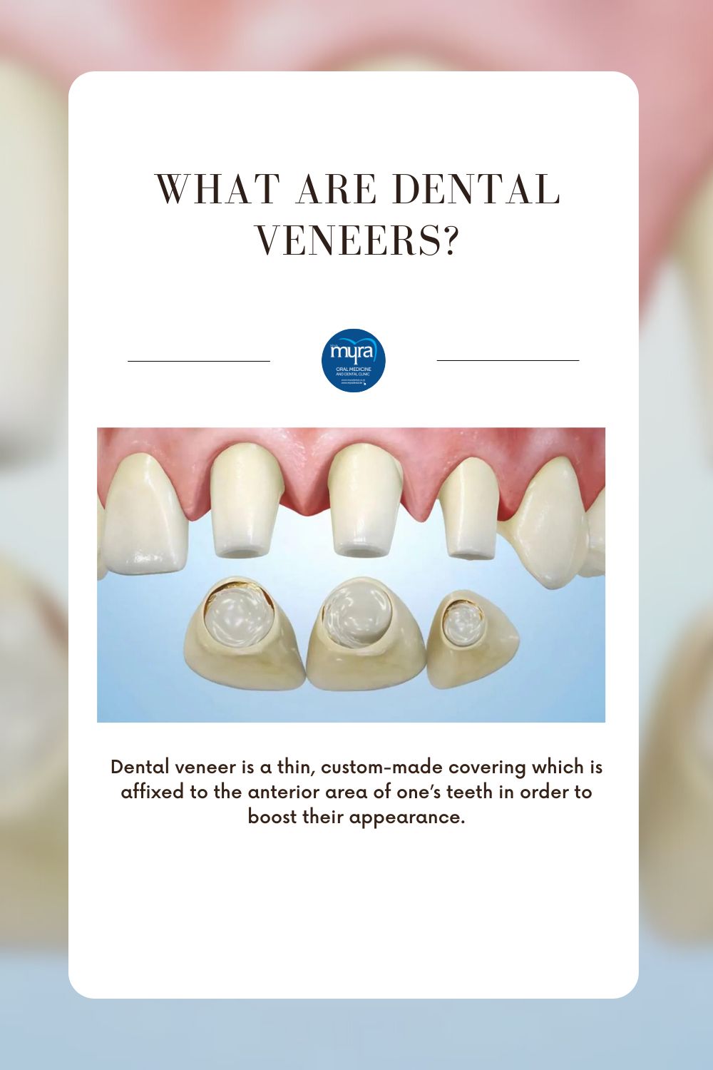 Erdem Çetin on LinkedIn: Dental Veneers: Definition, Types, Cost and ... Erdem Çetin on LinkedIn: Dental Veneers: Definition, Types, Cost and ...
