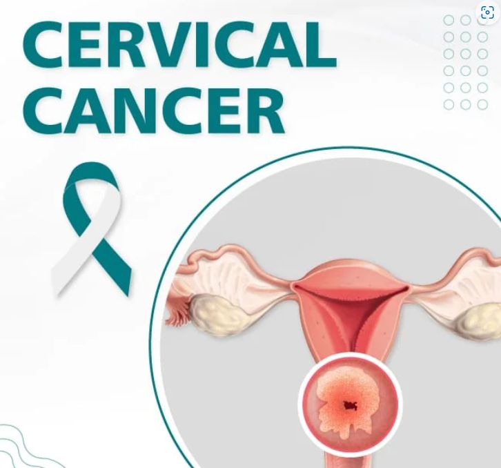 POOJA LAWANSHI on LinkedIn: #cervical_cancer_diagnostics #cervical # ... POOJA LAWANSHI on LinkedIn: #cervical_cancer_diagnostics #cervical # ...