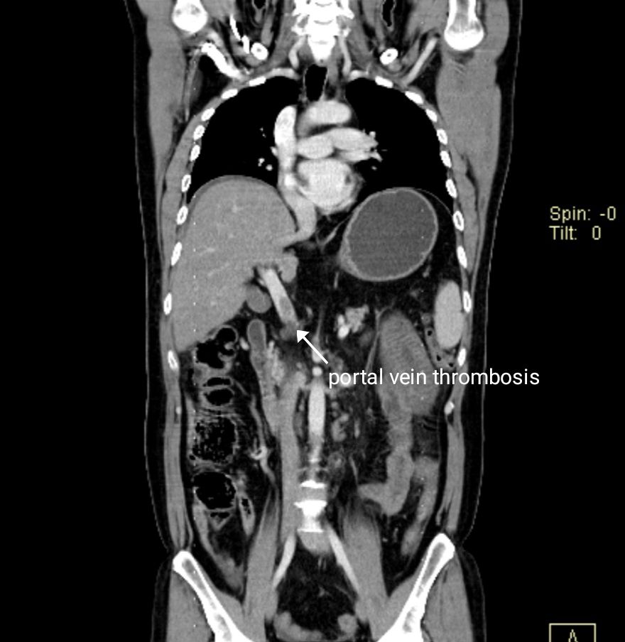 Owais Aleter on LinkedIn: 45-year-old male with cirrhosis. Ct scan with ... Owais Aleter on LinkedIn: 45-year-old male with cirrhosis. Ct scan with ...
