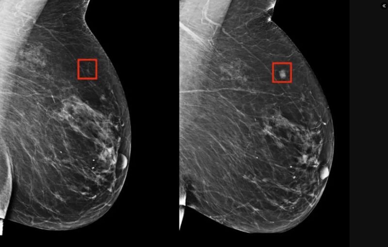 Siddharth Sai G on LinkedIn: Artificial intelligence detects breast ... Siddharth Sai G on LinkedIn: Artificial intelligence detects breast ...