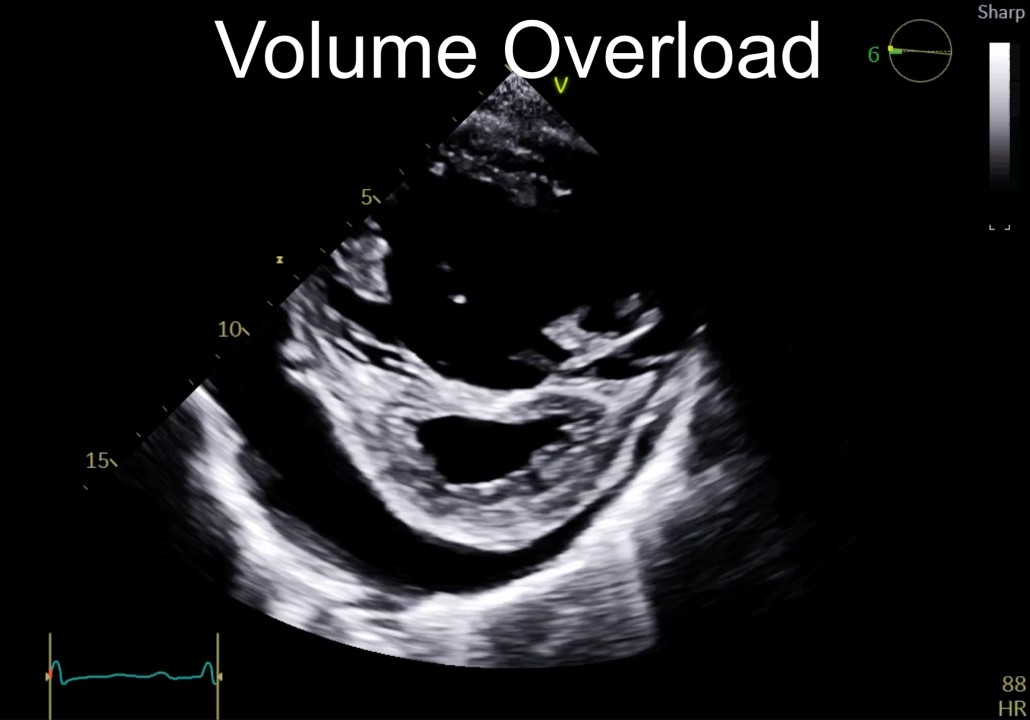 Billy Cathey, RDCS on LinkedIn: RVVO pt. 2. Here’s the post-op images ... Billy Cathey, RDCS on LinkedIn: RVVO pt. 2. Here’s the post-op images ...