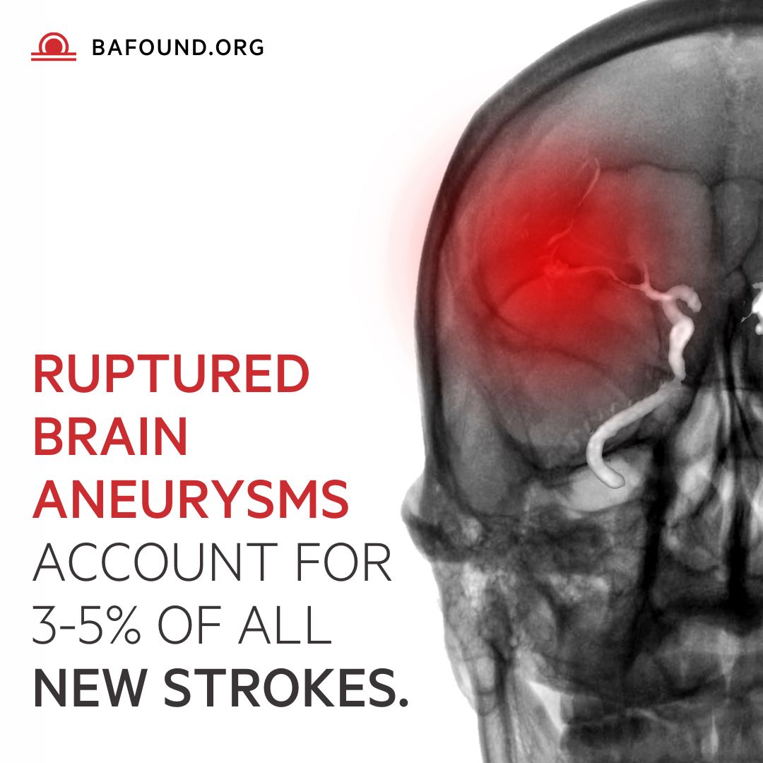 Brain Aneurysm Foundation on LinkedIn: #brainaneurysmawareness #stroke ... Brain Aneurysm Foundation on LinkedIn: #brainaneurysmawareness #stroke ...