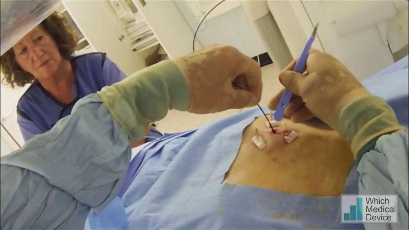 Which Medical Device Ltd on LinkedIn: Primary Button Gastrostomy Which Medical Device Ltd on LinkedIn: Primary Button Gastrostomy