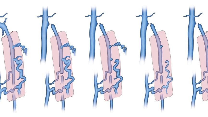 How standing long periods causes #VARICOCELE (treatments included ... How standing long periods causes #VARICOCELE (treatments included ...
