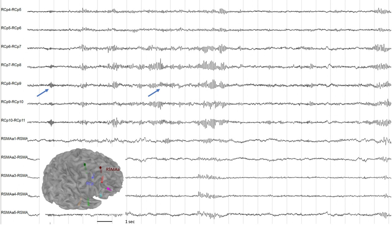 A Comprehensive Guide to Intracranial EEG A Comprehensive Guide to Intracranial EEG