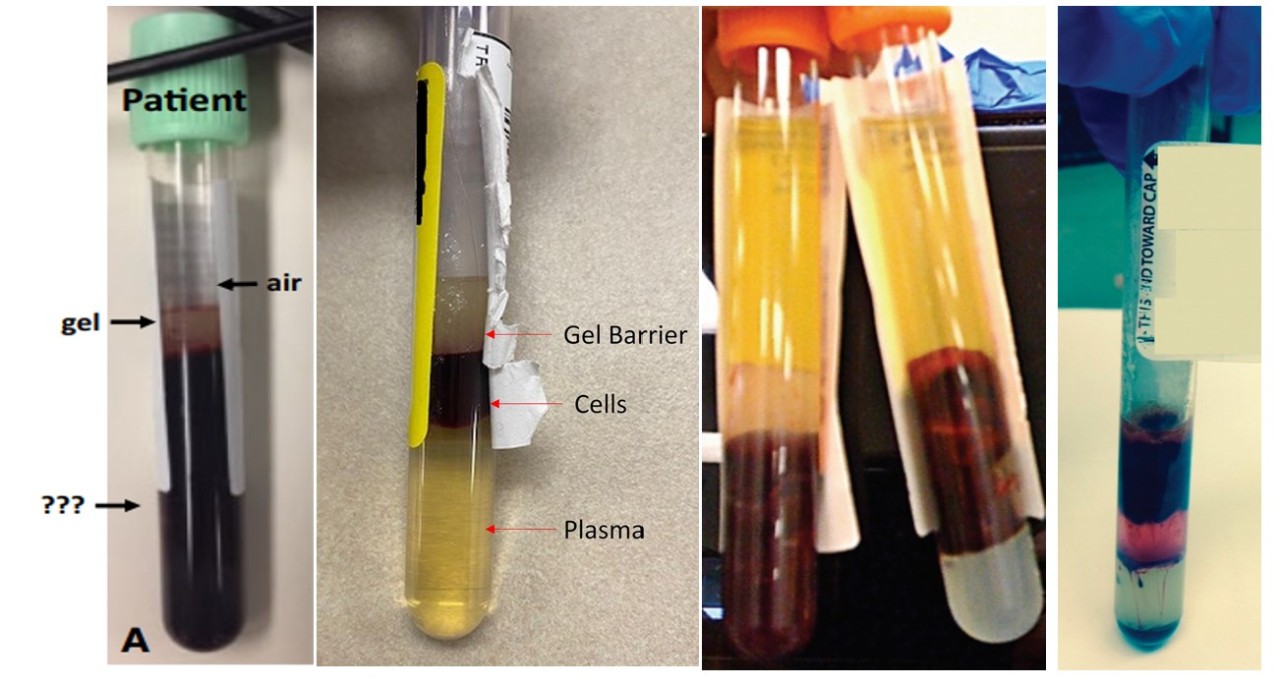 Errors in Specimen Collection and Processing Part 1 Errors in Specimen Collection and Processing Part 1