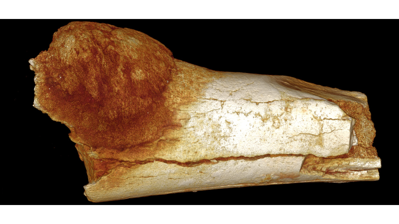 Tumor Board Review: Oldest Known Case of Cancer in early humans Tumor Board Review: Oldest Known Case of Cancer in early humans