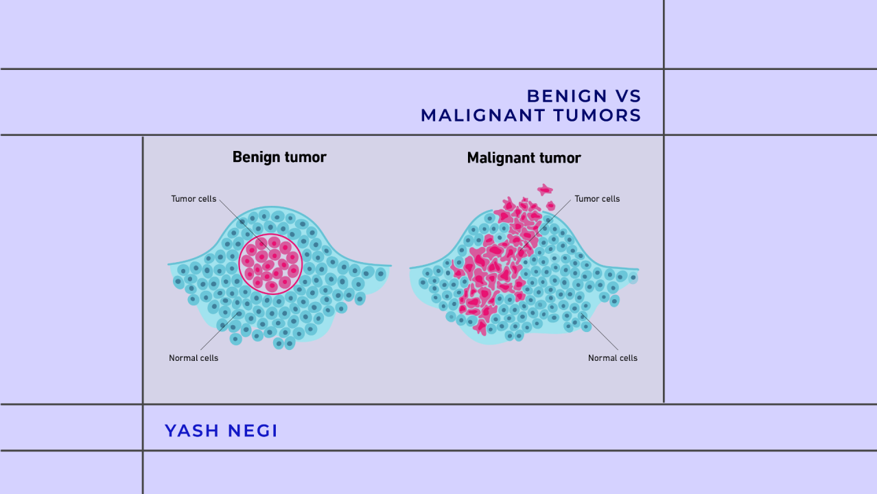 Understanding Tumors: Benign vs. Malignant Understanding Tumors: Benign vs. Malignant