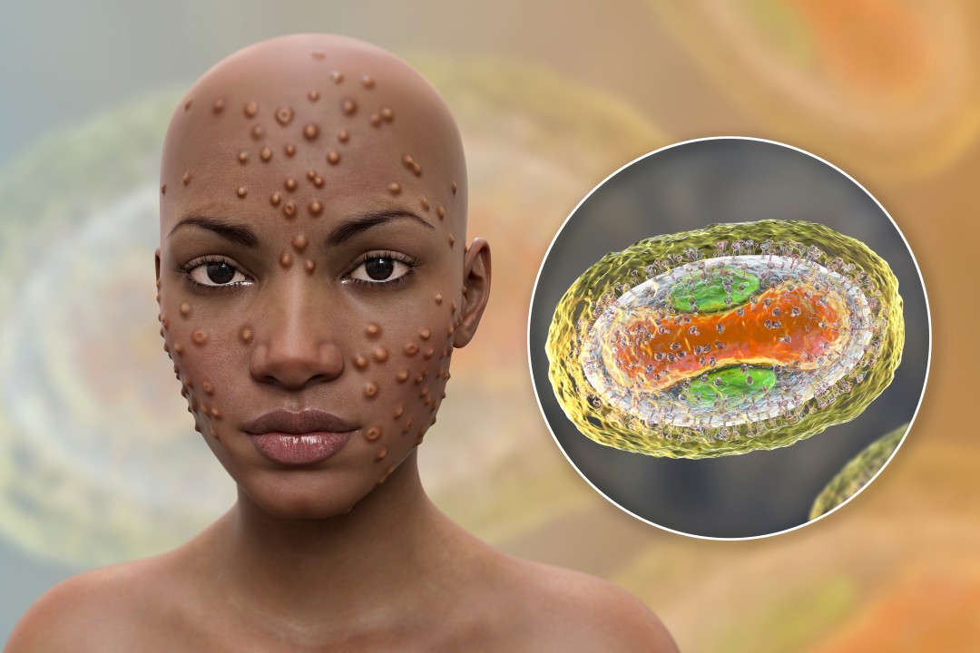 Monkeypox 101: Understanding the Basics Monkeypox 101: Understanding the Basics