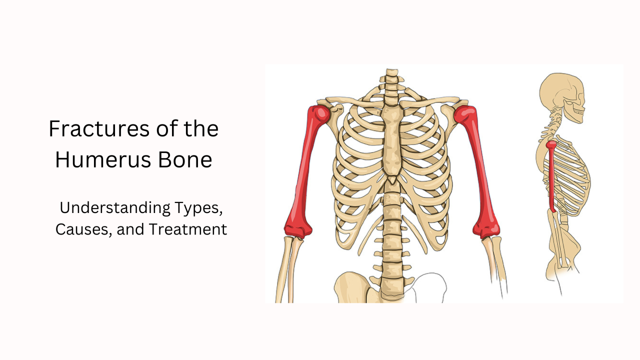 Fractures of the Humerus Bone : Understanding Types, Causes, and Treatment Fractures of the Humerus Bone : Understanding Types, Causes, and Treatment