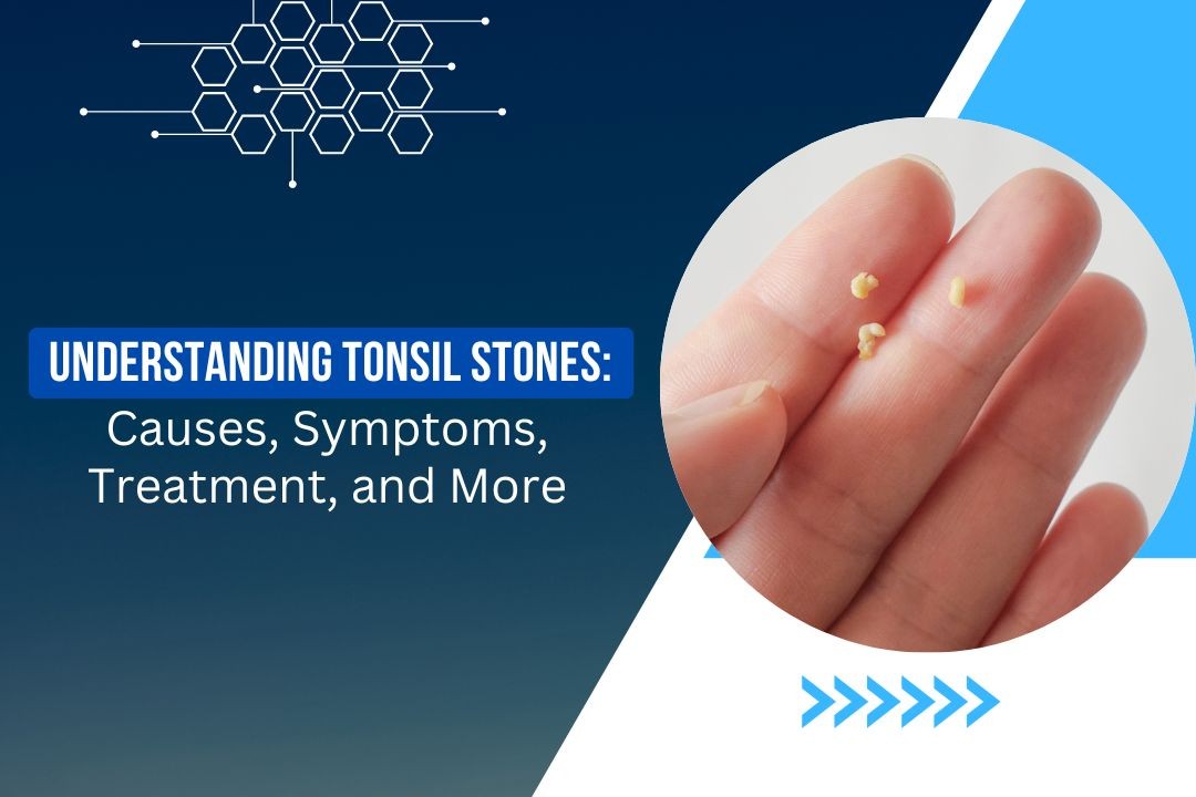 Understanding Tonsil Stones: Causes, Symptoms, Treatment, And More Understanding Tonsil Stones: Causes, Symptoms, Treatment, And More