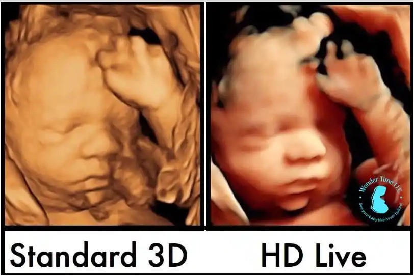 What's The Difference Between A 3D And 4D Ultrasound?, 46% OFF What's The Difference Between A 3D And 4D Ultrasound?, 46% OFF
