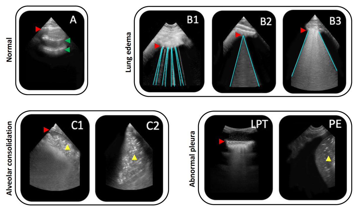 Lung Ultrasound to Assist ICU Admission Decision-Making Process of ... Lung Ultrasound to Assist ICU Admission Decision-Making Process of ...