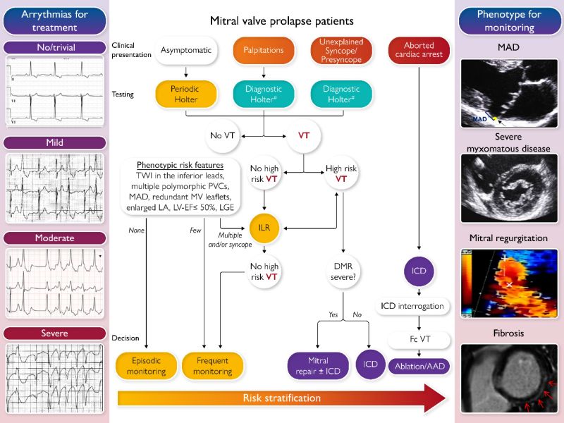 Hoda Noori on LinkedIn: 🎯Arrhythmic mitral valve prolapse and mitral ... Hoda Noori on LinkedIn: 🎯Arrhythmic mitral valve prolapse and mitral ...