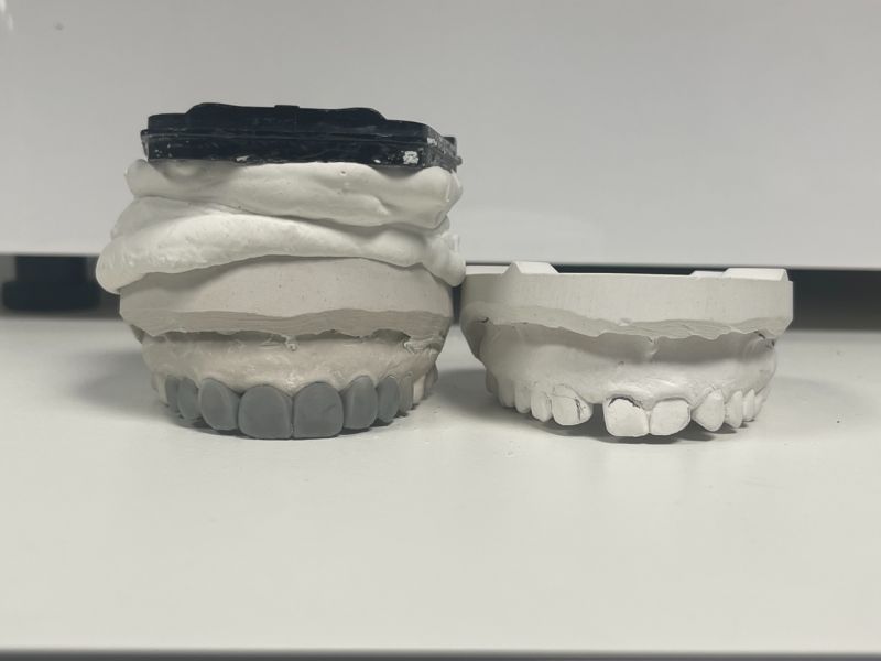 Nasrin Kheiri on LinkedIn: Snap on Smile Resin try on 3D printed Nasrin Kheiri on LinkedIn: Snap on Smile Resin try on 3D printed