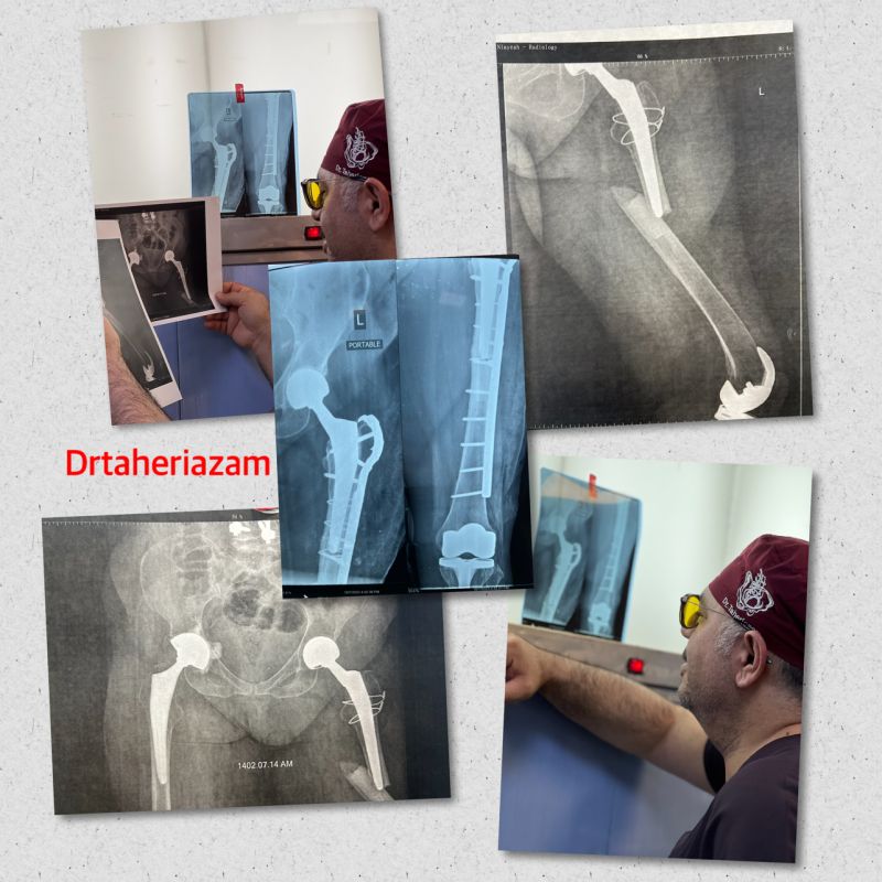 Assoc.Professor.Dr.Afshin Taheriazam on LinkedIn: #arthroplasty # ... Assoc.Professor.Dr.Afshin Taheriazam on LinkedIn: #arthroplasty # ...