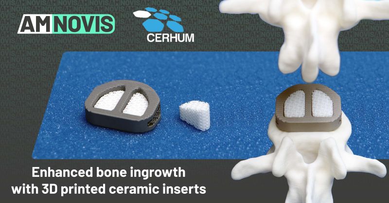 Amnovis on LinkedIn: Amnovis | Titanium 3D printing Amnovis on LinkedIn: Amnovis | Titanium 3D printing