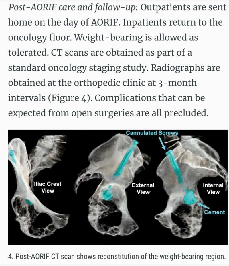 AORIF: Percutaneous management of osteolytic metastases | Francis Y ... AORIF: Percutaneous management of osteolytic metastases | Francis Y ...
