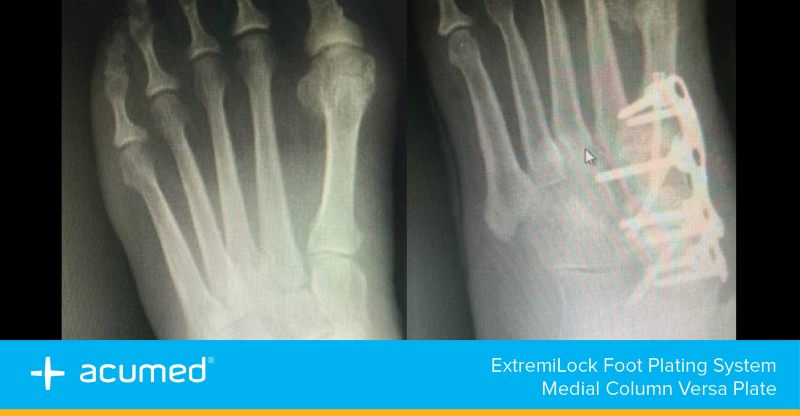 Acumed on LinkedIn: Acumed-Case-Study-ExtremiLock-FPS-Medial-Column ... Acumed on LinkedIn: Acumed-Case-Study-ExtremiLock-FPS-Medial-Column ...