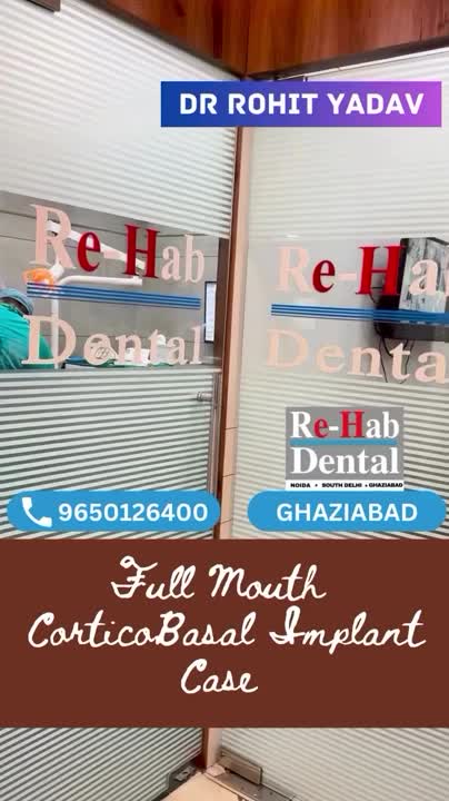 Dr. Rohit Yadav Implant Surgeon on LinkedIn: Dr. Rohit Yadav Full Mouth ... Dr. Rohit Yadav Implant Surgeon on LinkedIn: Dr. Rohit Yadav Full Mouth ...