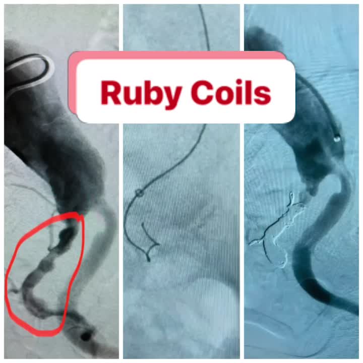 Ruben Garcia (CVT) on LinkedIn: Penumbra Ruby Coils The Penumbra ... Ruben Garcia (CVT) on LinkedIn: Penumbra Ruby Coils The Penumbra ...