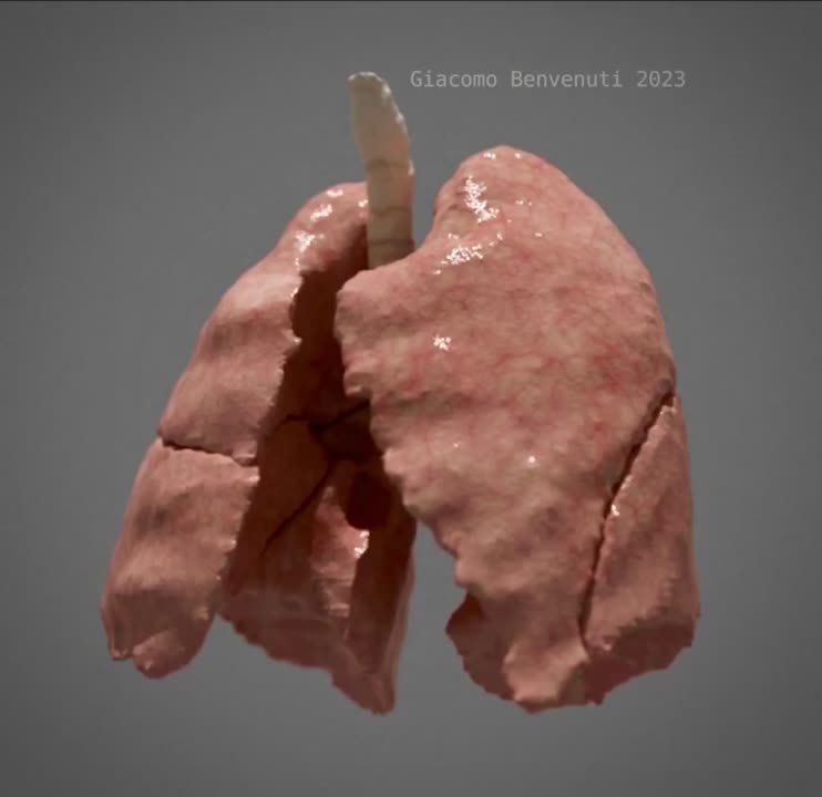 Giacomo Benvenuti on LinkedIn: #ild #lung #medical #biology # ... Giacomo Benvenuti on LinkedIn: #ild #lung #medical #biology # ...