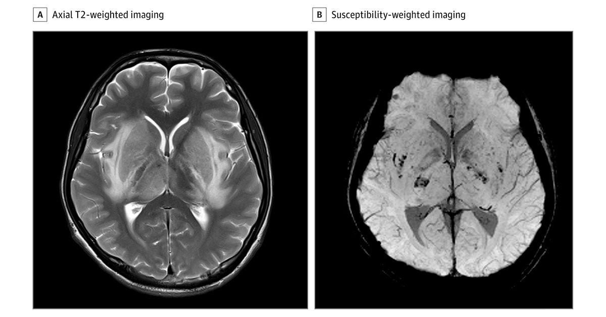 JAMA Neurology on LinkedIn: Most viewed in the last 7 days from JAMA ... JAMA Neurology on LinkedIn: Most viewed in the last 7 days from JAMA ...