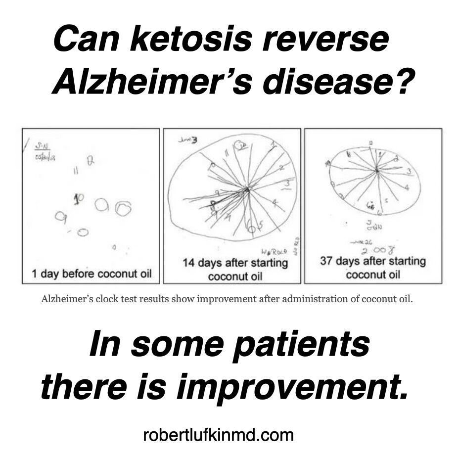 Robert Lufkin MD on LinkedIn: #alzheimer Robert Lufkin MD on LinkedIn: #alzheimer