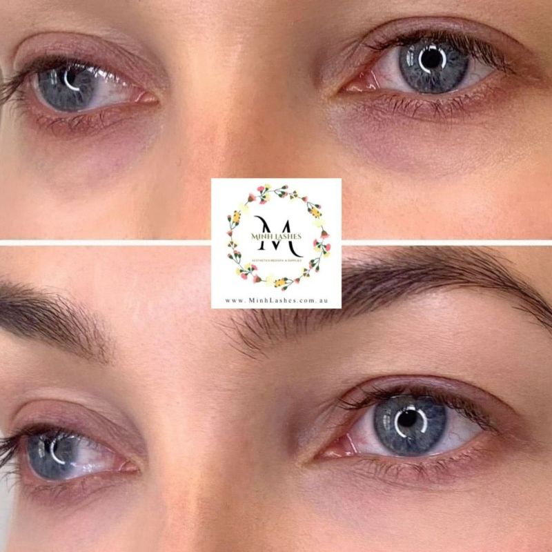 Minh Lashes Beauty Clinic on LinkedIn: #teartroughs #youthfuleyes # ... Minh Lashes Beauty Clinic on LinkedIn: #teartroughs #youthfuleyes # ...