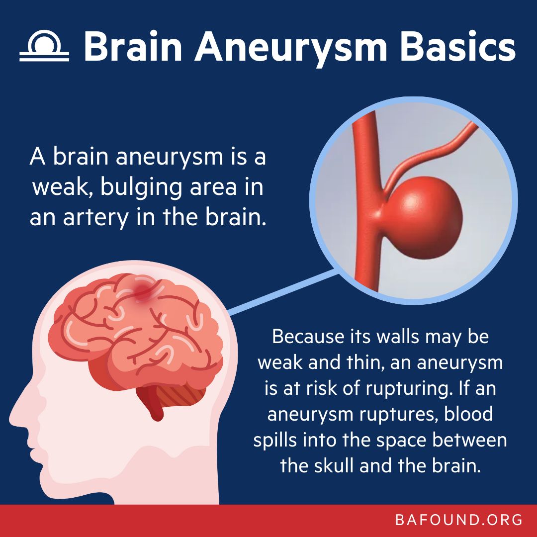 Brain Aneurysm Foundation on LinkedIn: Brain Aneurysm Basics! Education ... Brain Aneurysm Foundation on LinkedIn: Brain Aneurysm Basics! Education ...
