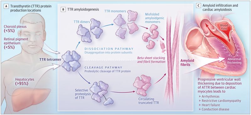 JAMA on LinkedIn: Amyloidosis from transthyretin (ATTR) can cause ... JAMA on LinkedIn: Amyloidosis from transthyretin (ATTR) can cause ...
