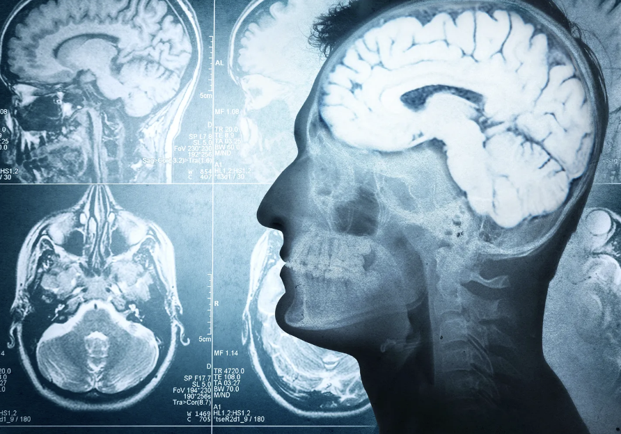 Unveiling the Hidden Culprit: Beyond Amyloid Plaques in Alzheimer's Disease Unveiling the Hidden Culprit: Beyond Amyloid Plaques in Alzheimer's Disease