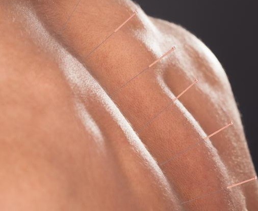 How can Acupuncture help me? How can Acupuncture help me?