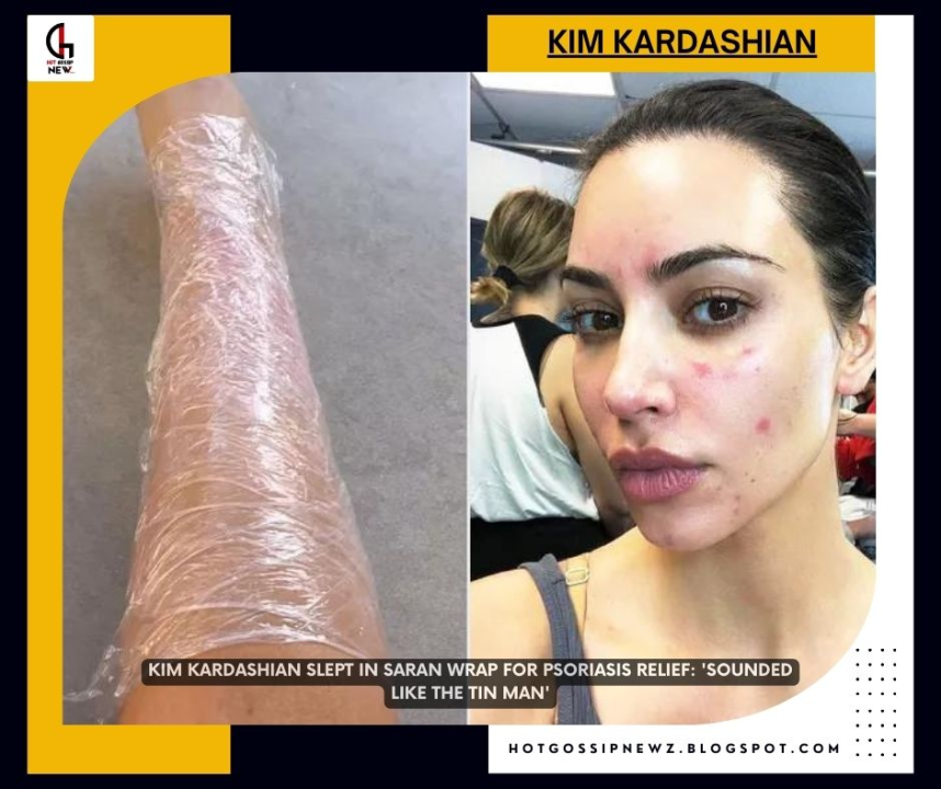 Kim Kardashian Reflects on Managing Psoriasis with Unconventional Remedies Kim Kardashian Reflects on Managing Psoriasis with Unconventional Remedies