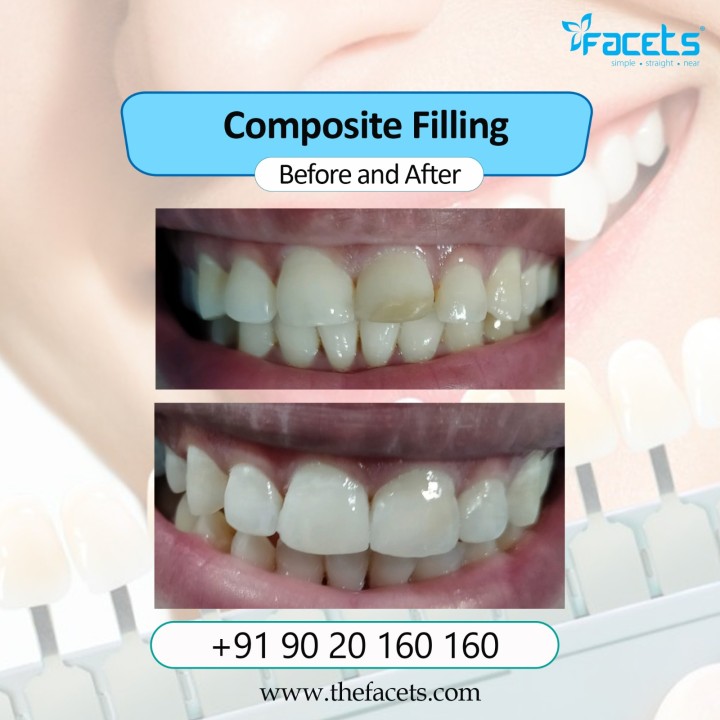 Restoring Your Smile: Composite Fillings for Tooth Discoloration 😁 Restoring Your Smile: Composite Fillings for Tooth Discoloration 😁