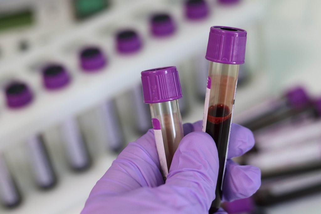 Global Ovarian Cancer Diagnostics Market Size And Forecast 2023-2030 Global Ovarian Cancer Diagnostics Market Size And Forecast 2023-2030