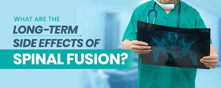 The Truth About Spinal Fusion Surgery: Debunking Common Myths The Truth About Spinal Fusion Surgery: Debunking Common Myths