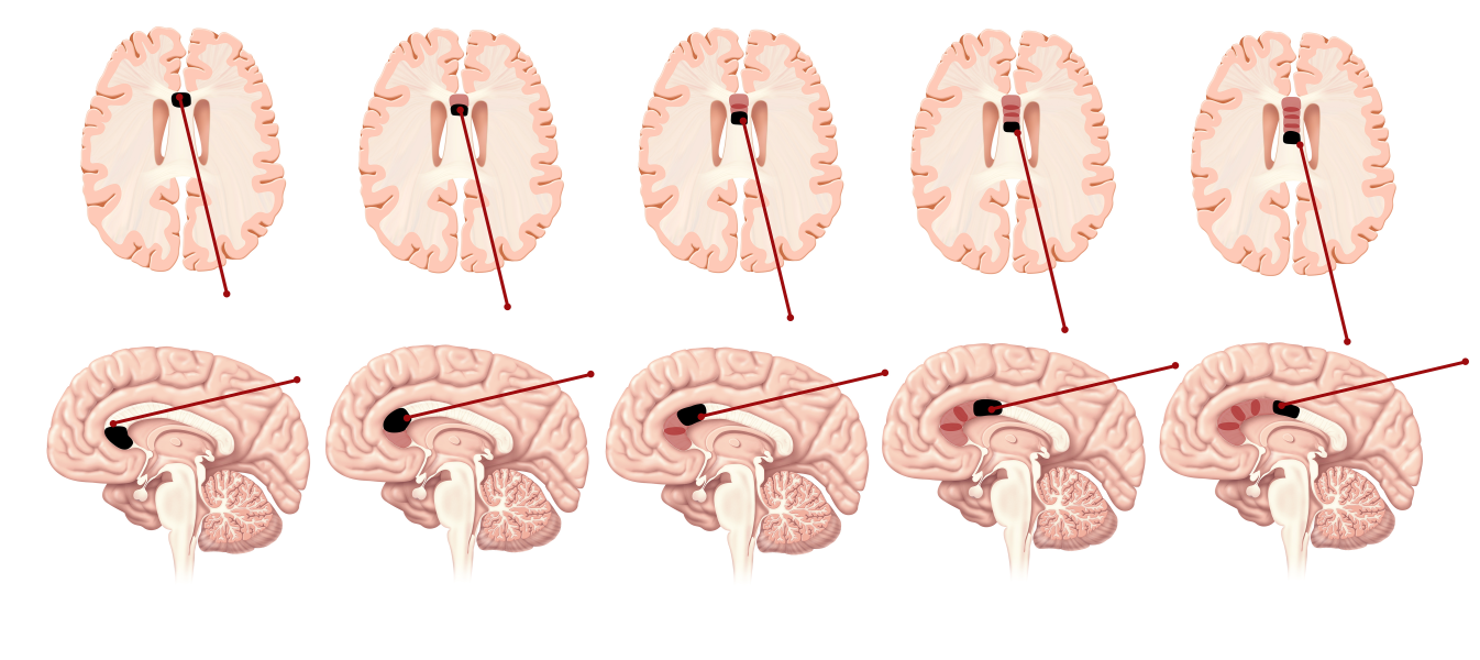 Article on Epilepsy and the Corpus Callosotomy Article on Epilepsy and the Corpus Callosotomy