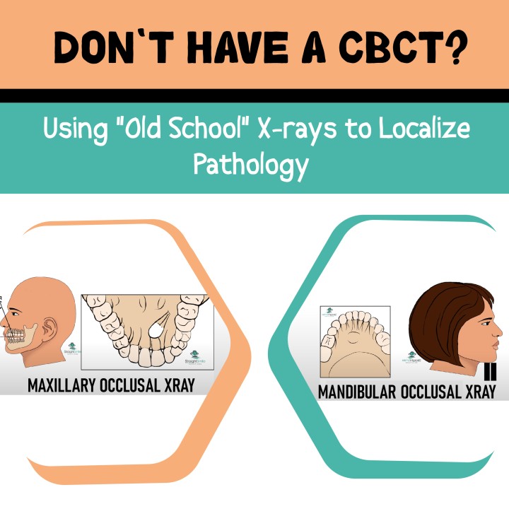 “Old School” Ways to Localize Pathology without a CBCT “Old School” Ways to Localize Pathology without a CBCT