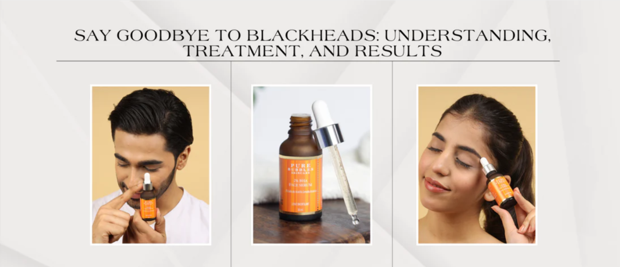 Say Goodbye to Blackheads: Understanding, Treatment, and Results. Say Goodbye to Blackheads: Understanding, Treatment, and Results.