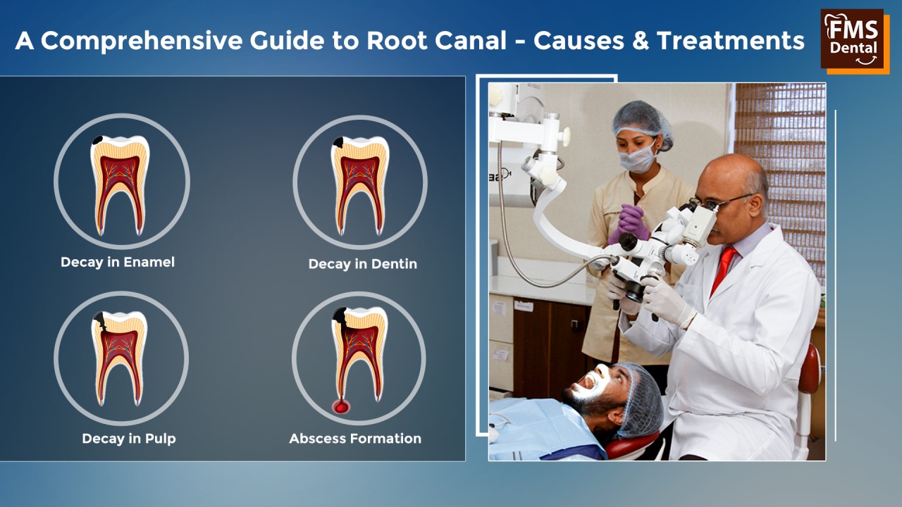 A Comprehensive Guide to Root Canal - Causes & Treatments A Comprehensive Guide to Root Canal - Causes & Treatments