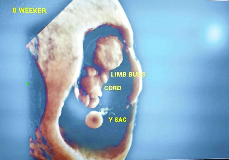 Echosonic Fetocare on LinkedIn: #ultrasound #fetalmedicine Echosonic Fetocare on LinkedIn: #ultrasound #fetalmedicine