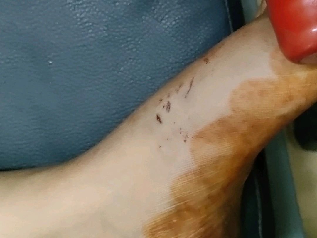 Prithviraj Singh on LinkedIn: snake bite Mark's Prithviraj Singh on LinkedIn: snake bite Mark's